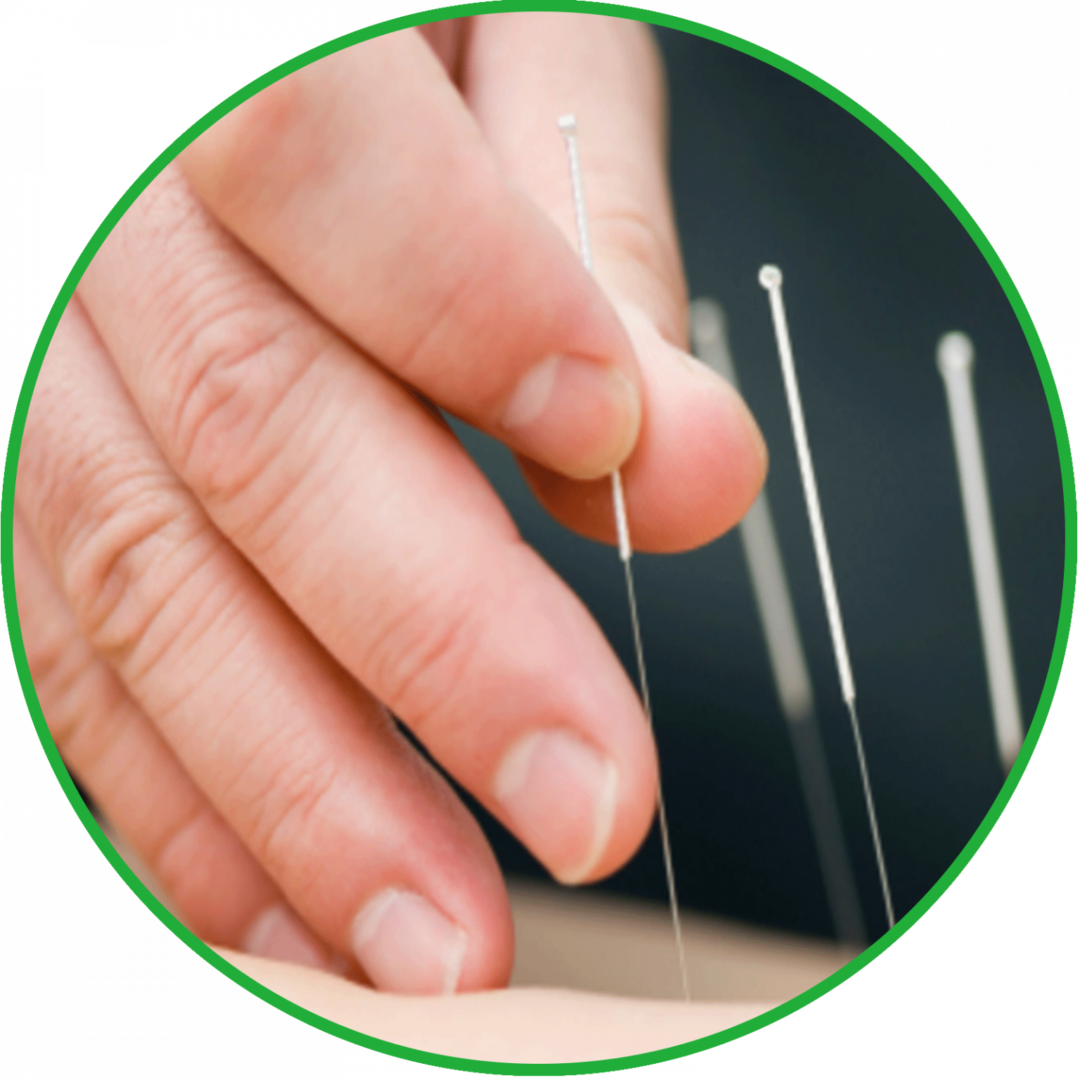 Traditional Chinese Acupuncture | The Traditional Way Clinic